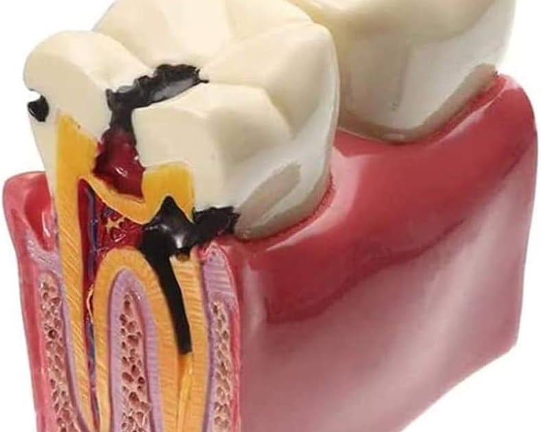 Dental Caries Model | JSDental